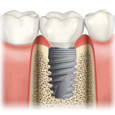 Zubni Implanti: Izbor Broj 1 za Savršen Osmeh | Dentalux